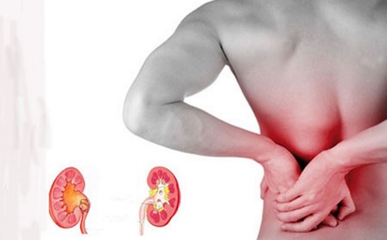 Cálculos Renales Y Ureterales Litiasis Dr Jorge E Sedano Basilio